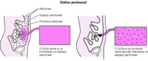 Diálise peritoneal – SBN