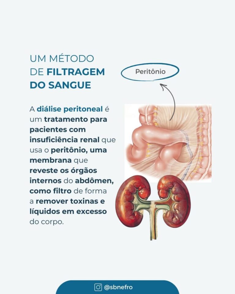 SBN Explica: O que é Diálise Peritoneal e como ela funciona? – SBN
